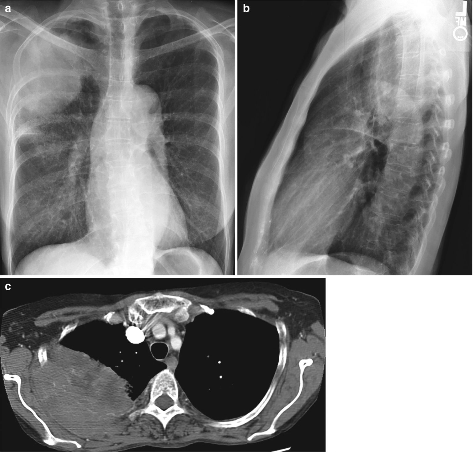 Left Cardiac Border X Ray Lungs Mediastinum and Pleura Springerlink ...